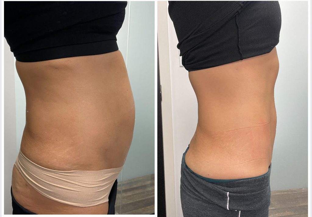 Transform Your Body with EMS Sculpt | Dr. Pacholec